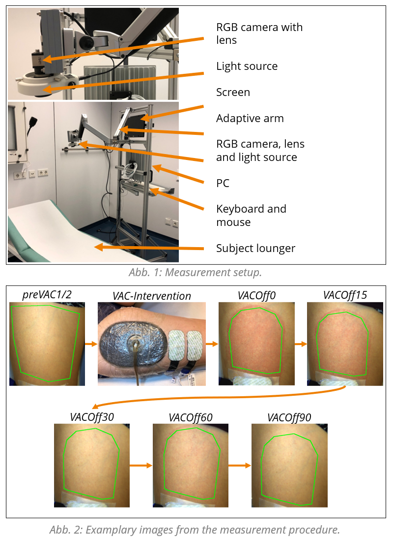 Camera-based photoplethysmography (cbPPG) to measure the change in ... Camera-based photoplethysmography (cbPPG) to measure the change in ...